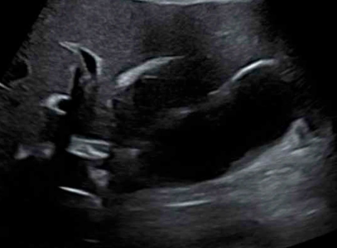 Biliary POCUS